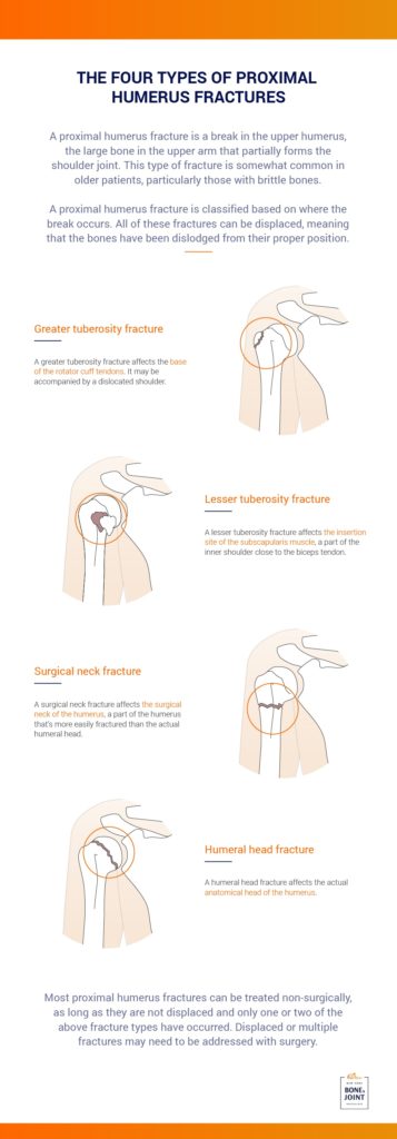 Humerus Fracture Specialist in NYC | NY Bone & Joint