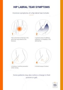 How to Recognize the Symptoms of (and Seek Treatment for) a Hip Labral ...