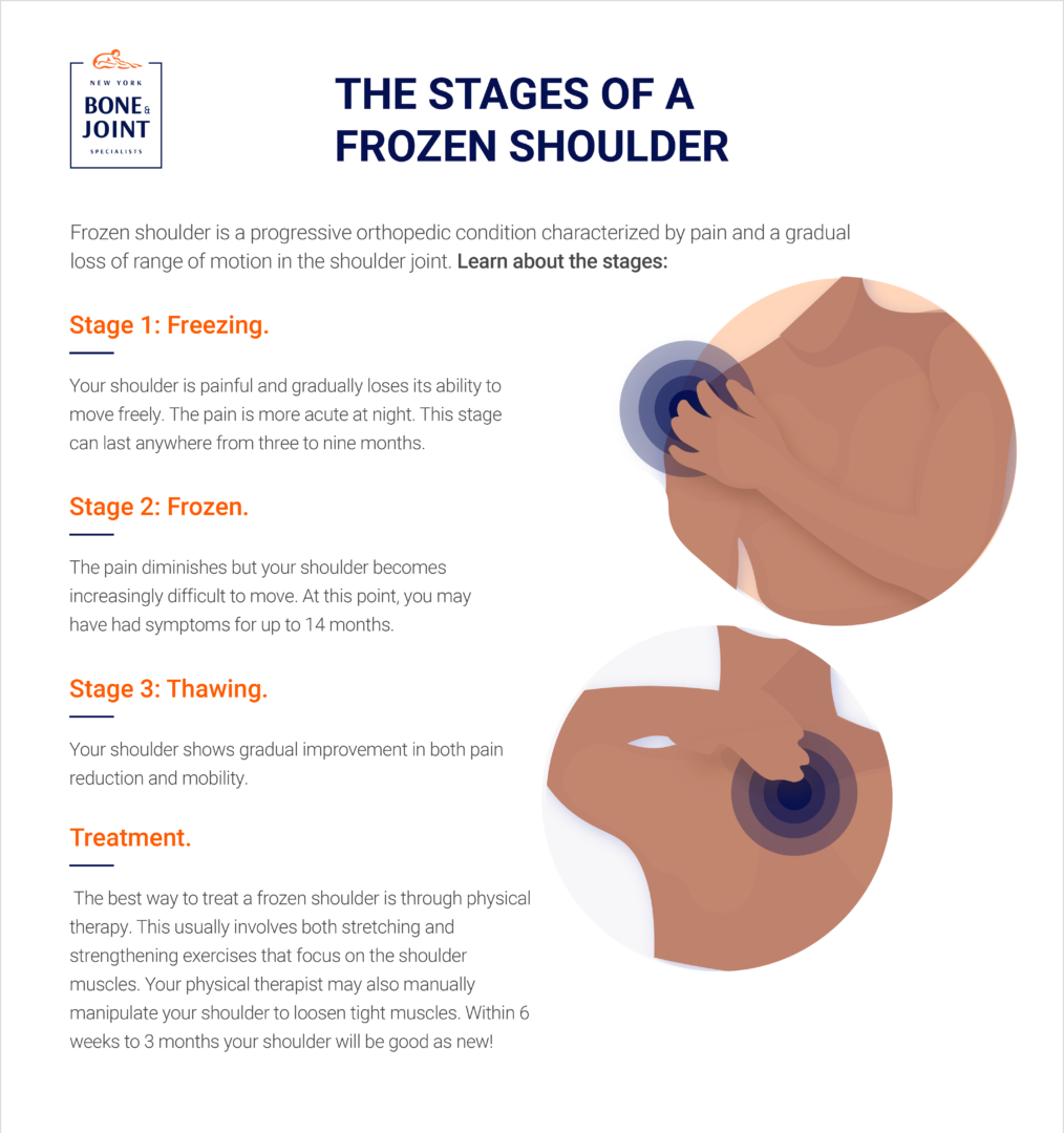 Thaw Your Frozen Shoulder with this Treatment Guide - New York Bone ...